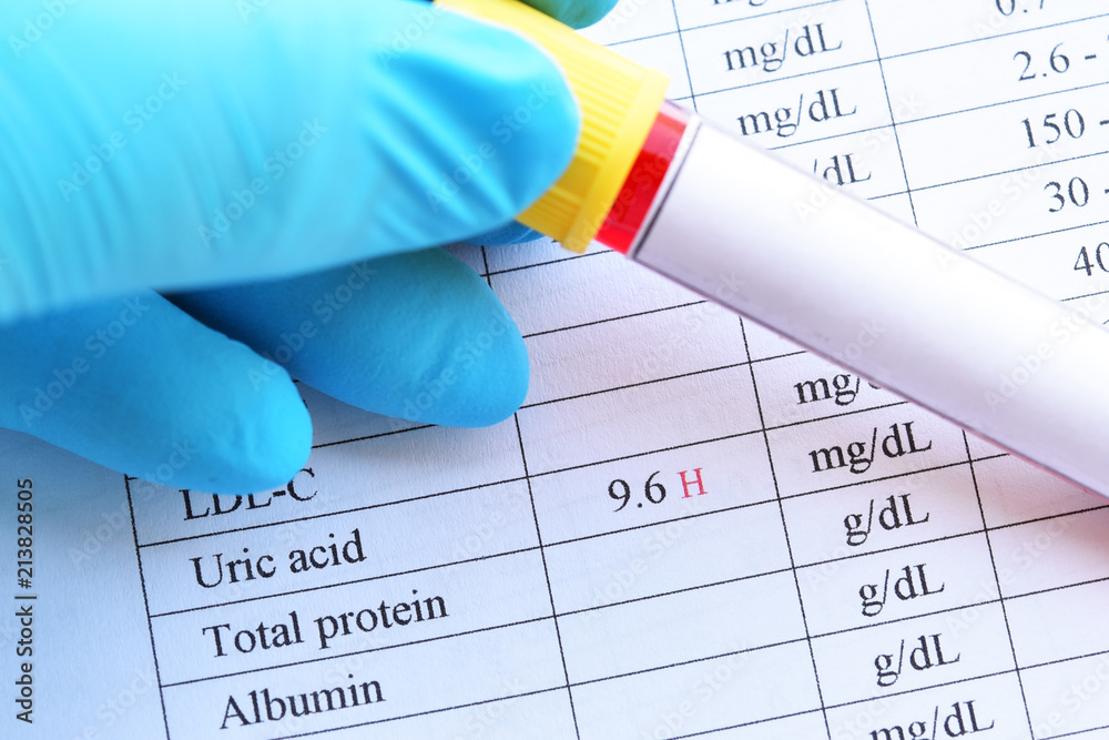 Blood sample tube with abnormal high uric acid test result Stock Photo ...