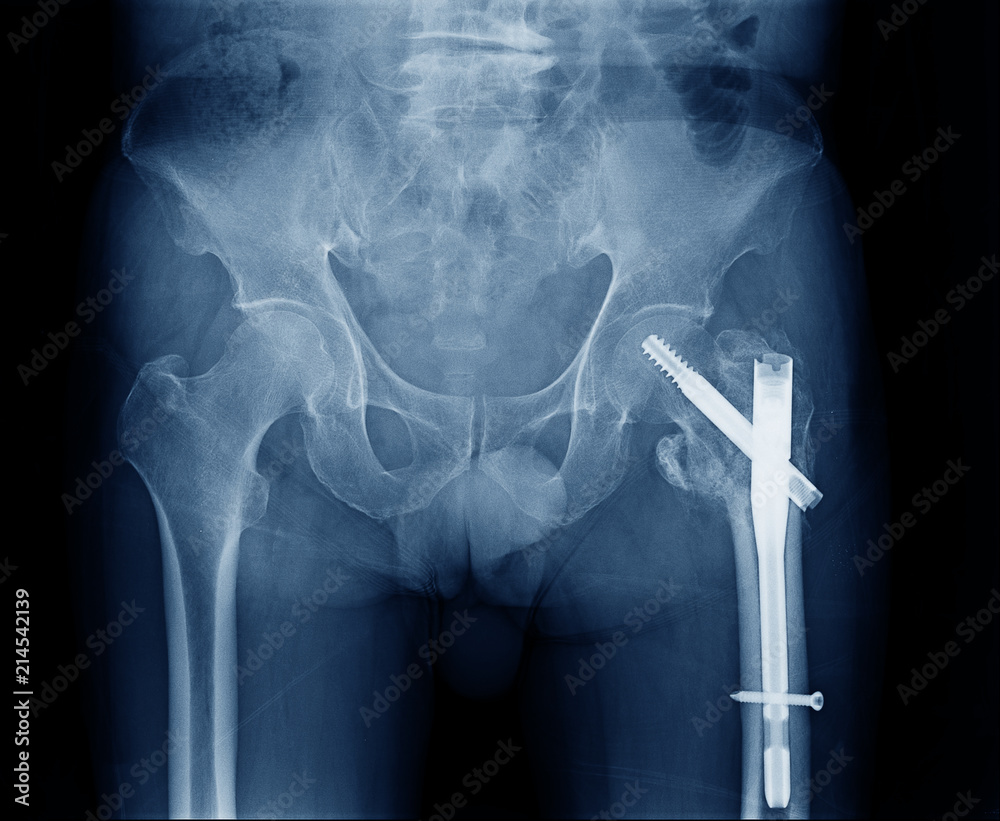 X-ray image of left side human hip fracture neck of femur bone. Open ...