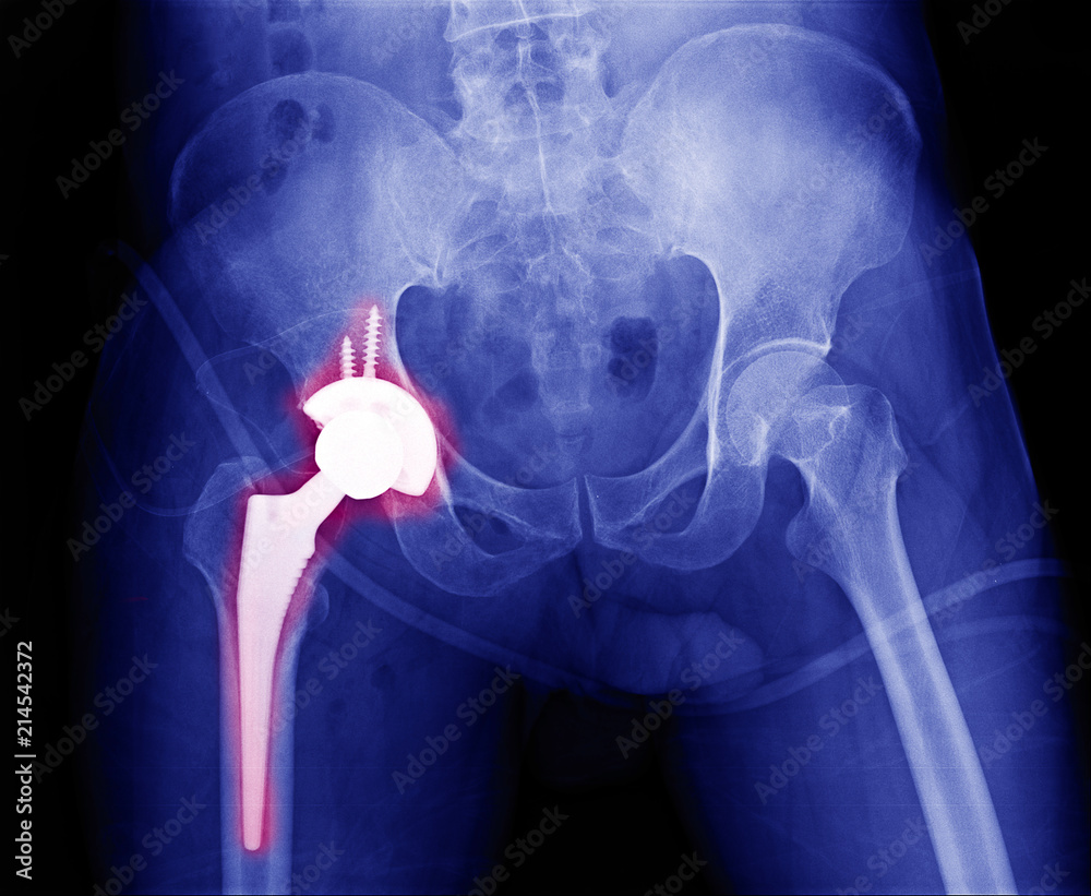 Foto x-ray image of both hip, Showing total Hip joint Replacement and ...