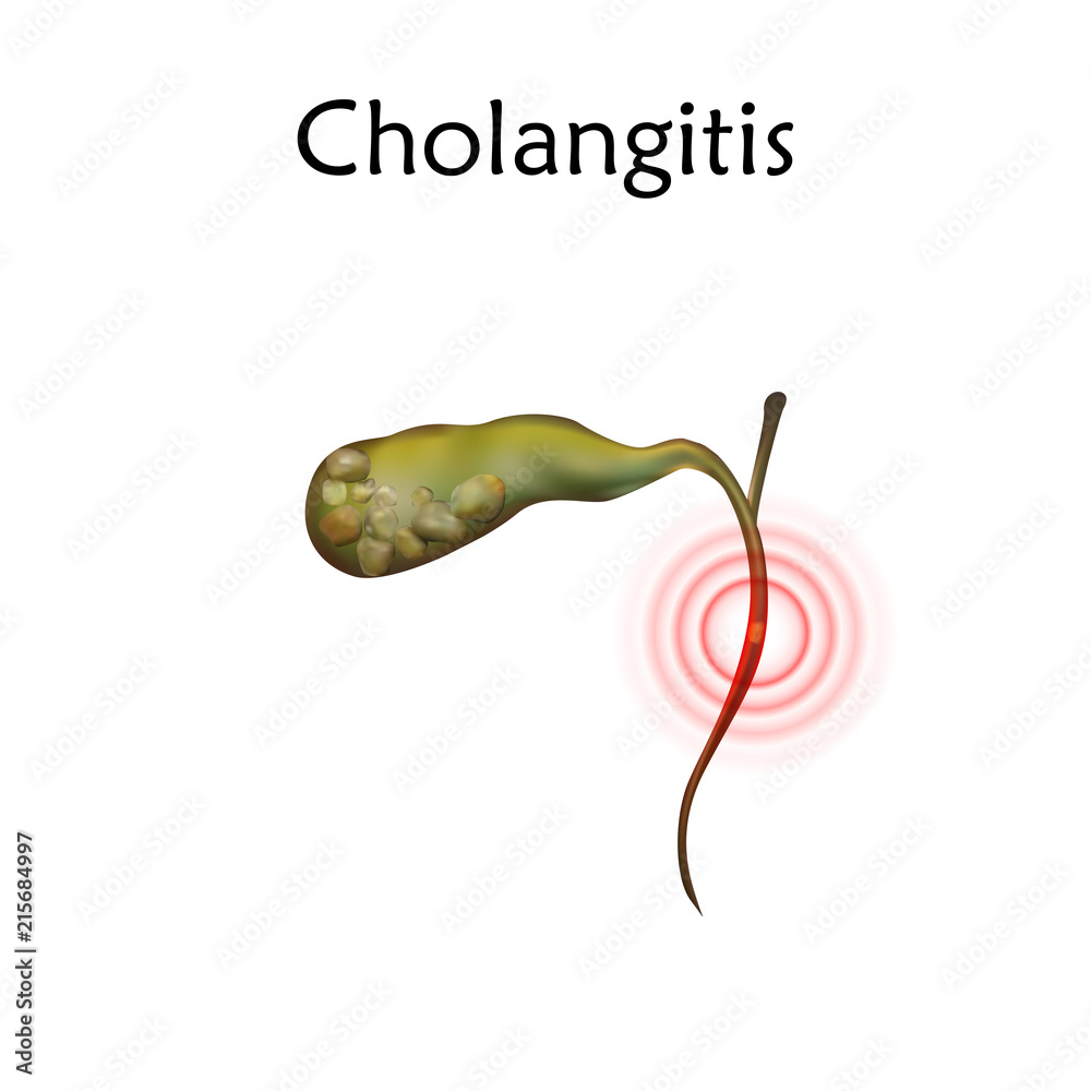 Gallbladder disease, inflammation, gallstone blocks common bile duct ...