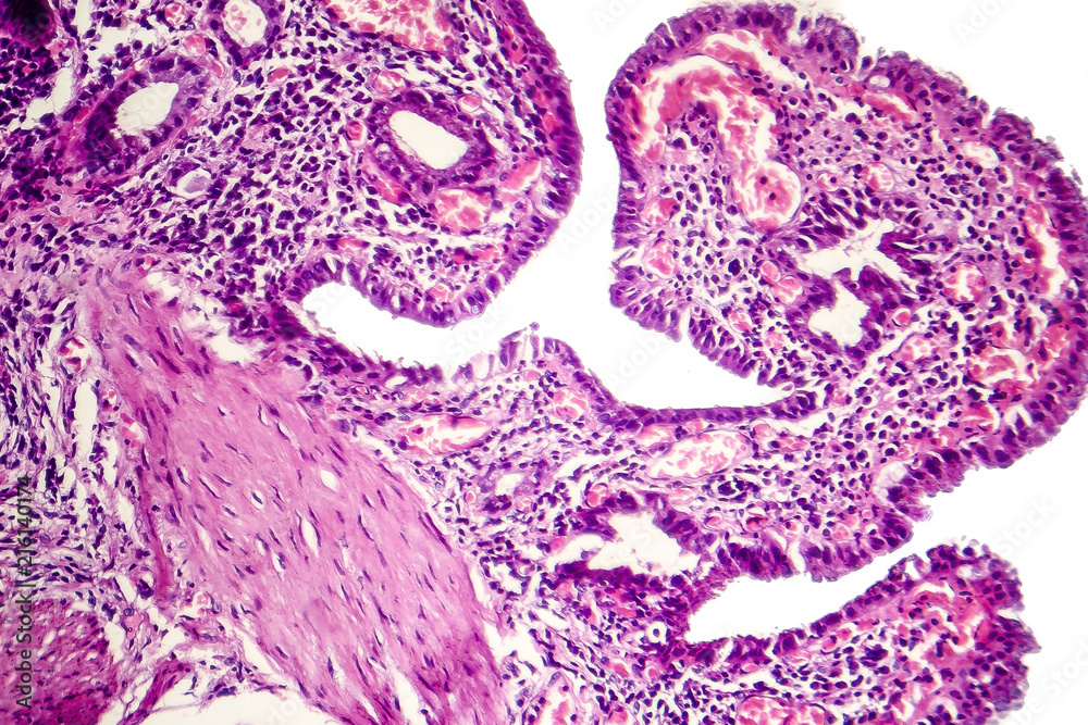 Foto de Stock Chronic cholecystitis, light micrograph, photo under ...
