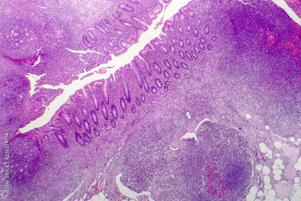 Stock-Foto „Suppurative appendicitis, light micrograph, photo under ...