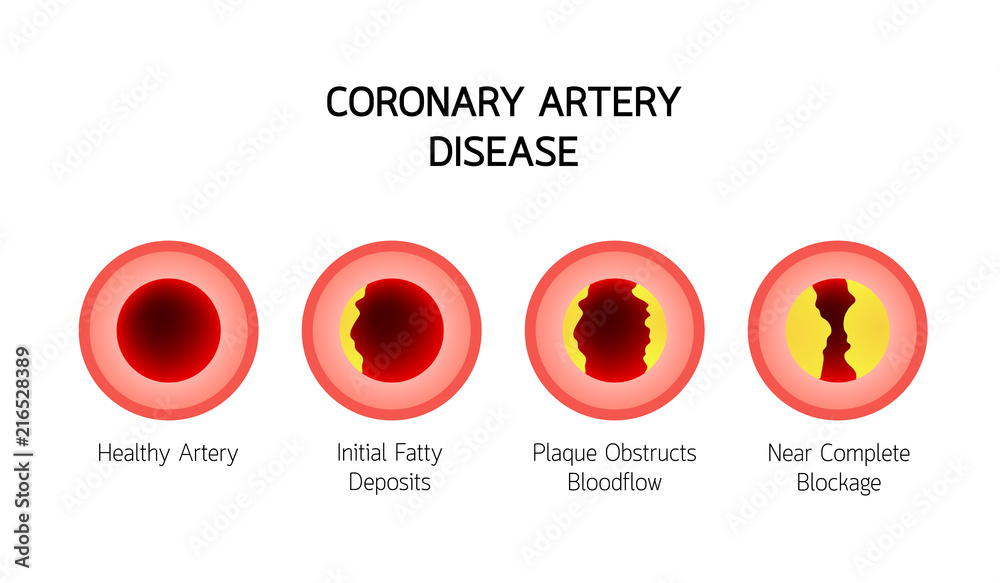 Coronary Artery Disease infographic. Heart awareness concept ...