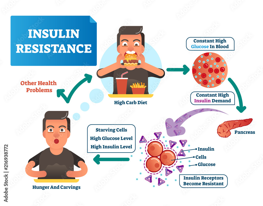 Insulin resistance vector illustration. Labeled scheme with all cycle ...