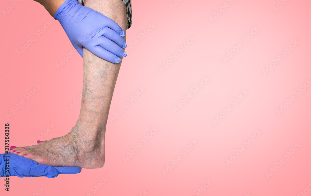 Lower limb vascular examination because suspect of venous insufficiency ...