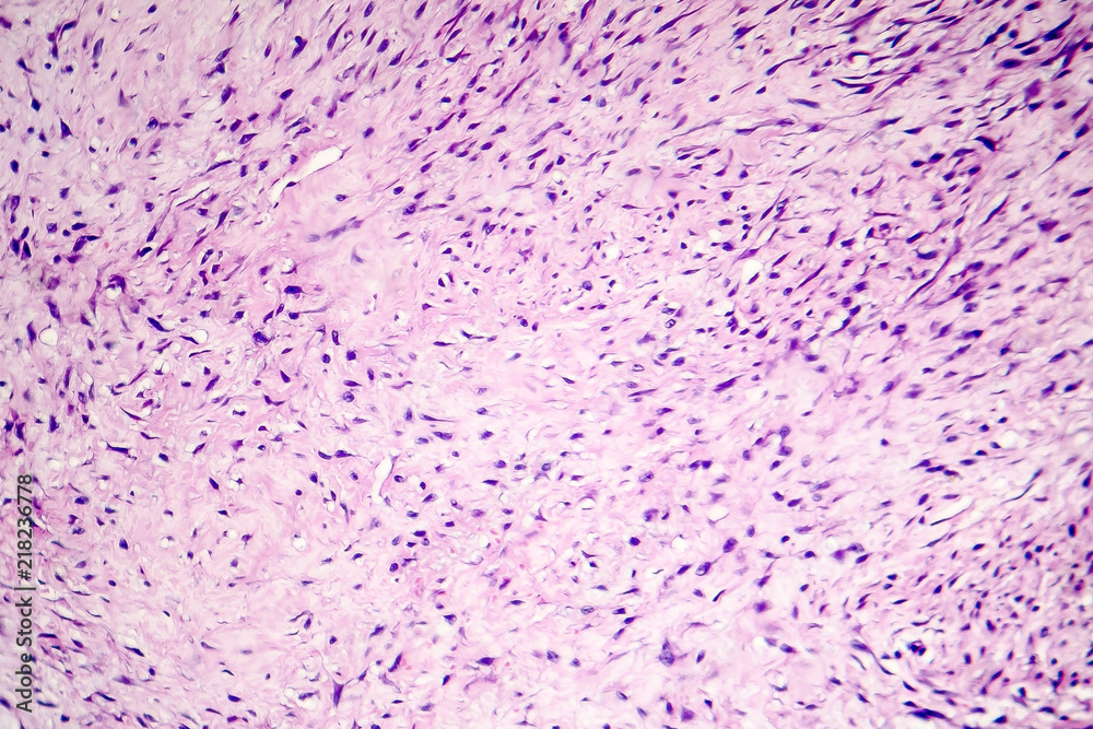 Fibroma, a benign tumour of fibrous tissue, light micrograph, photo ...