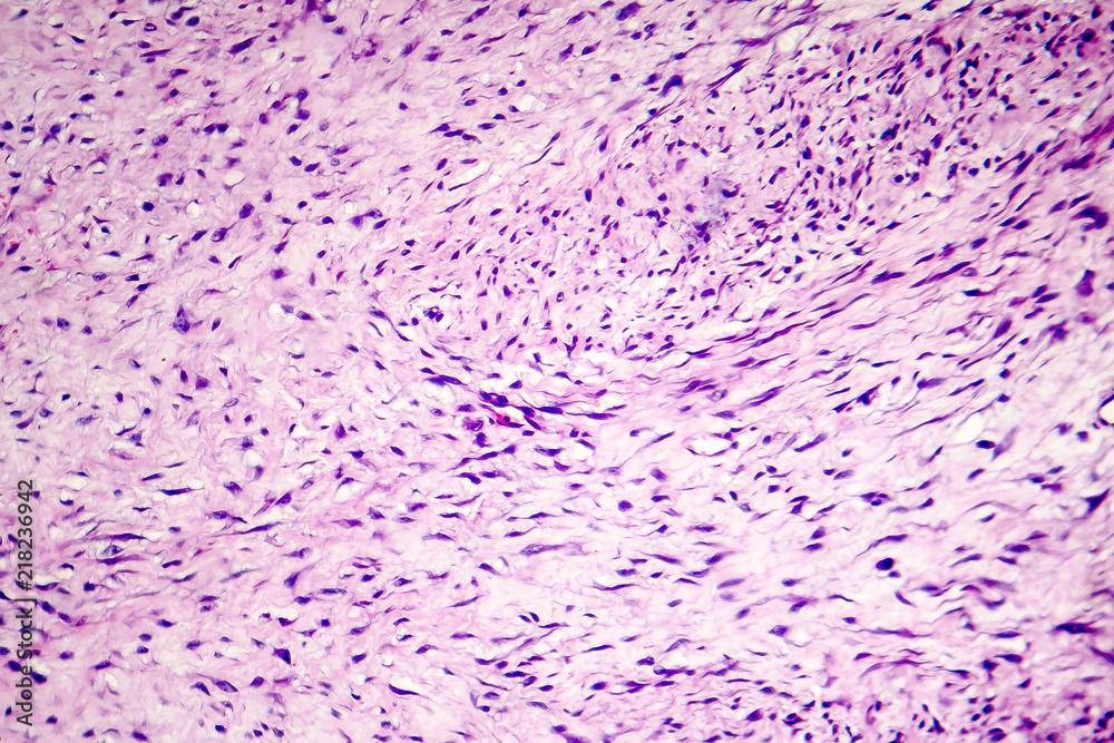 Fibroma, a benign tumour of fibrous tissue, light micrograph, photo ...