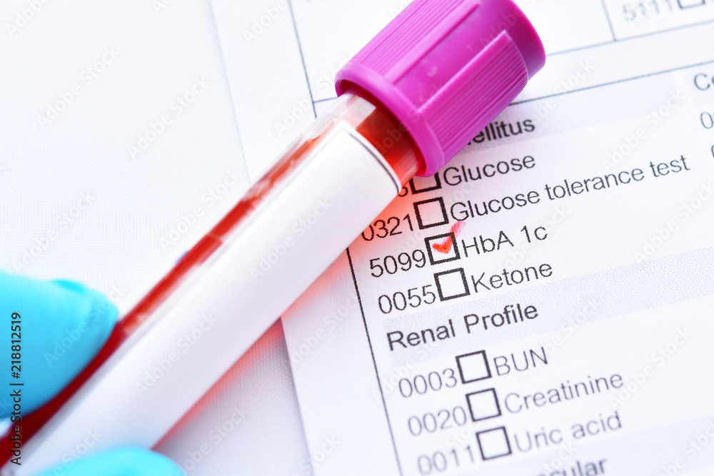 Blood sample tube with laboratory requisition form for HbA1c test ...