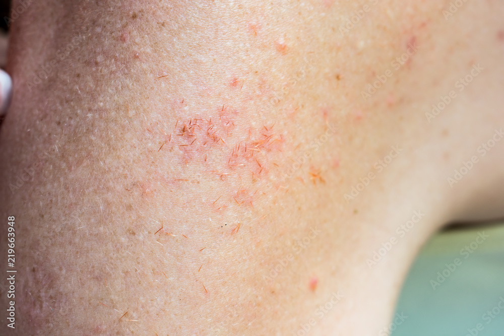 Rash on skin caused by cactus needles. Stock Photo | Adobe Stock