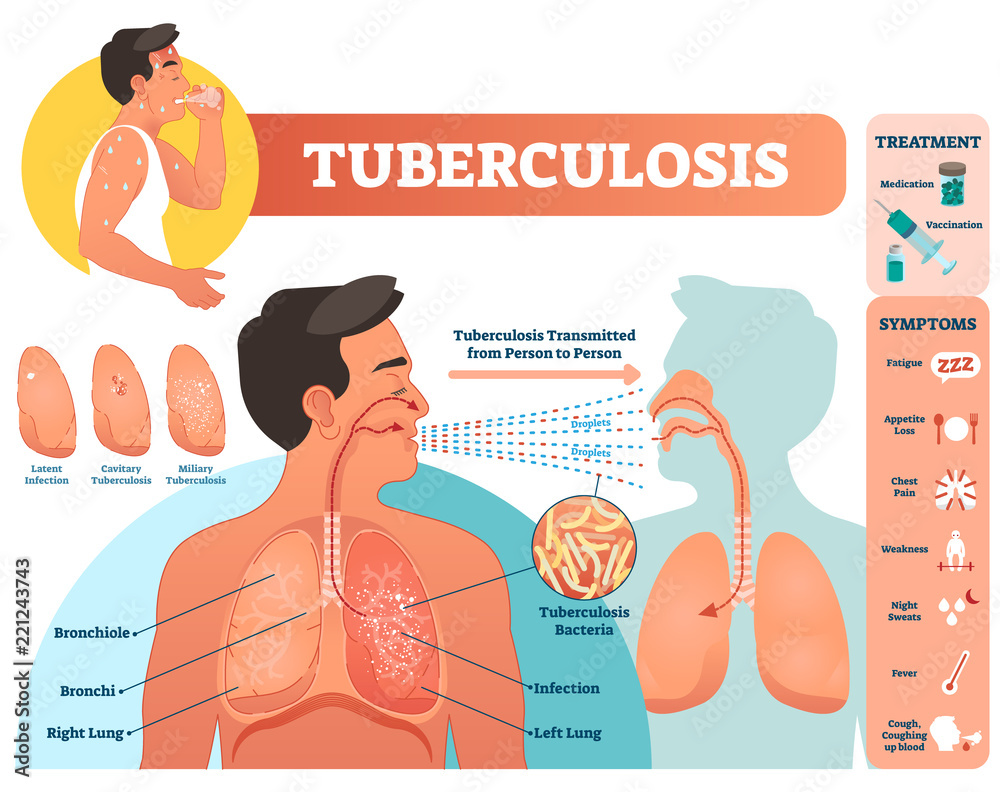 Vector de Stock Tuberculosis vector illustration. Detailed symptoms and ...