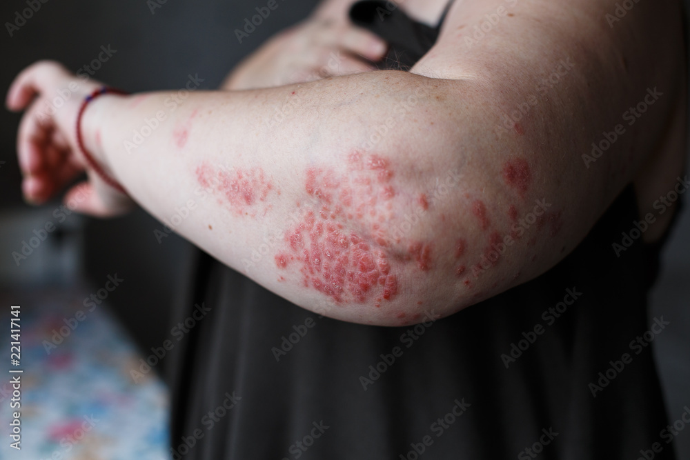 Psoriasis vulgaris on the womans hands with plaque, rash and patches on ...