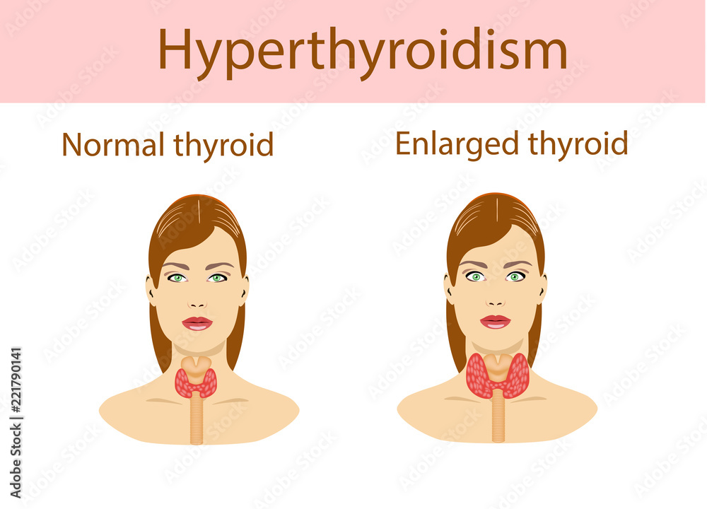 Woman with enlarged hyperthyroid gland. Vector illustration. Stock ...