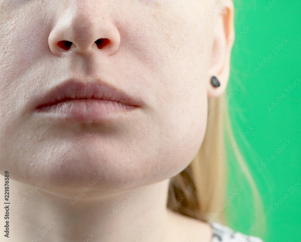 Teeth Problem. Gumboil, flux and swelling of the cheek. Closeup Of ...