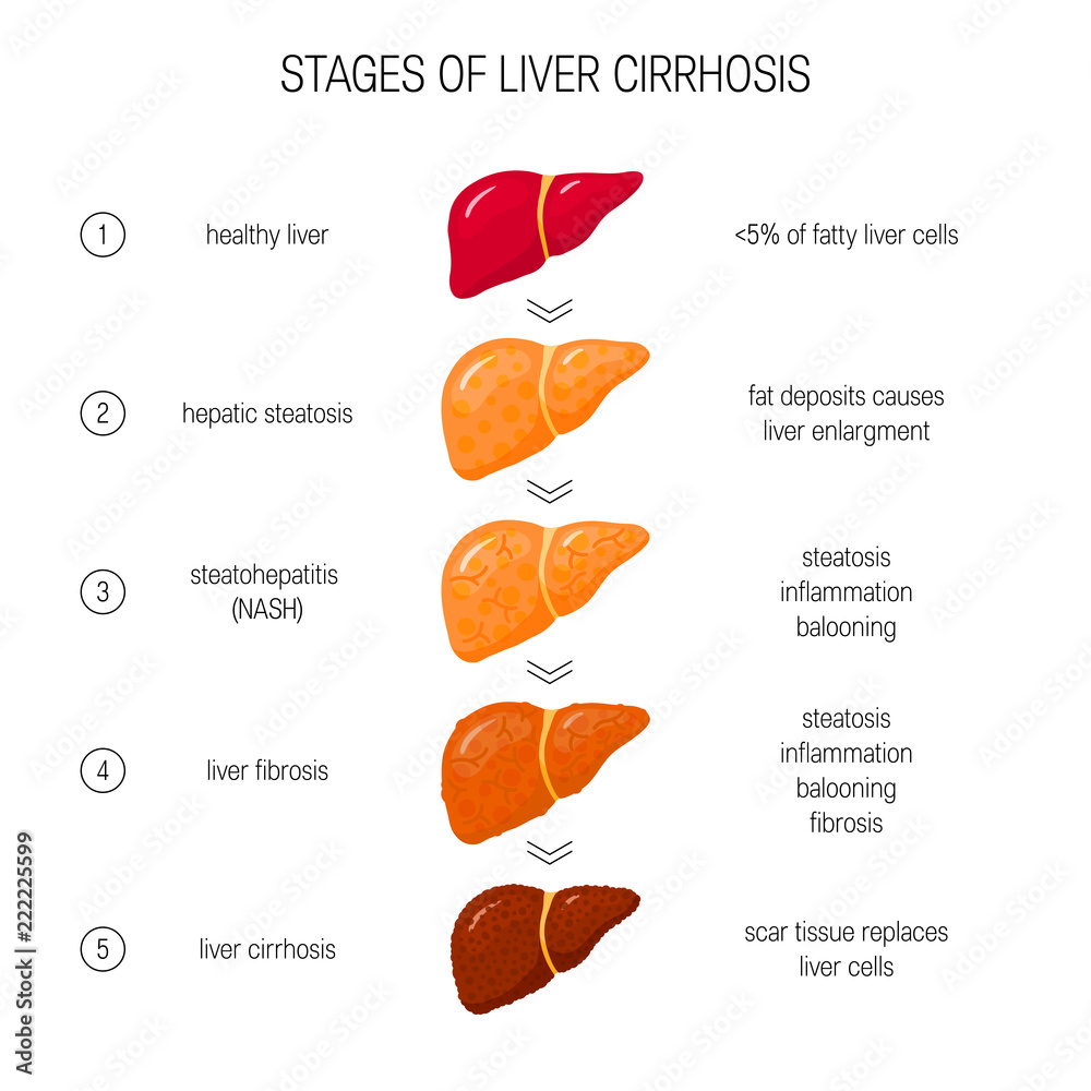 Liver failure vector concept Stock Illustration | Adobe Stock