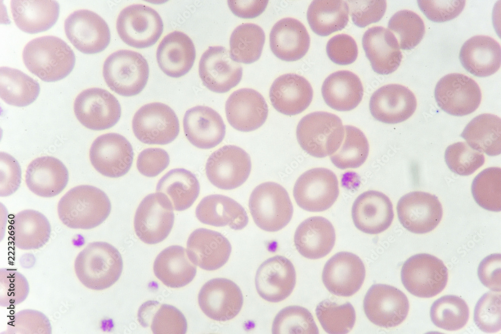 Target cells with abnormal red blood cells from anemia patient, analyze ...