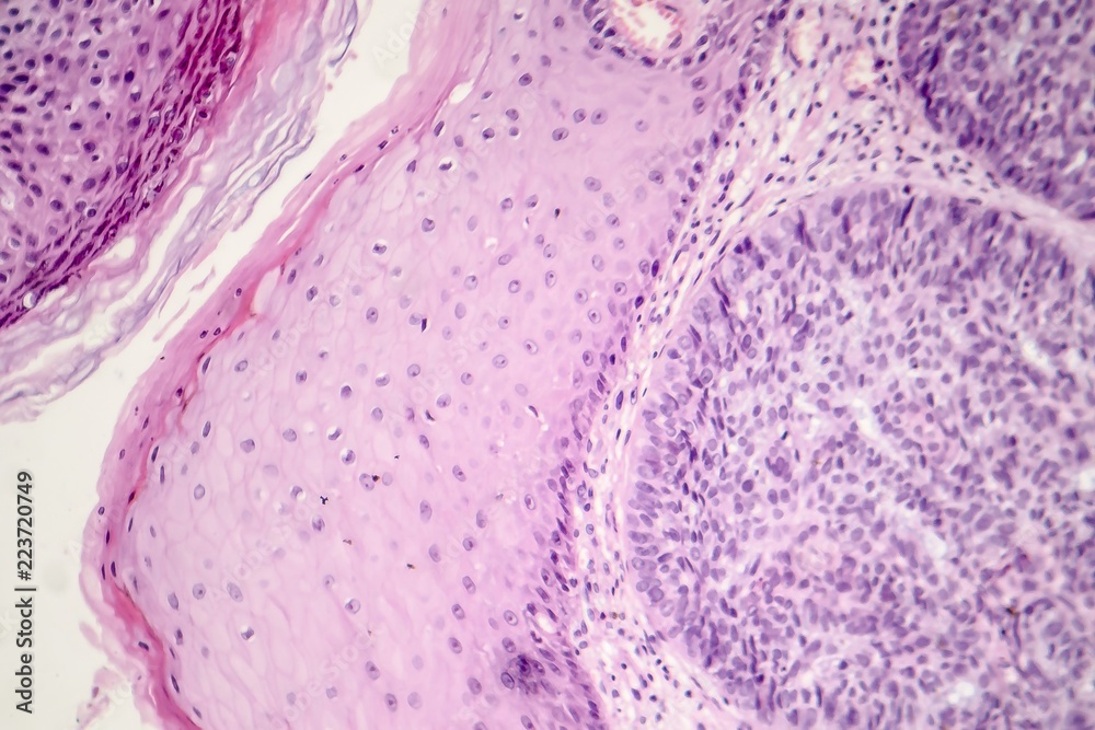 Basal cell carcinoma, skin cancer, light micrograph, photo under ...