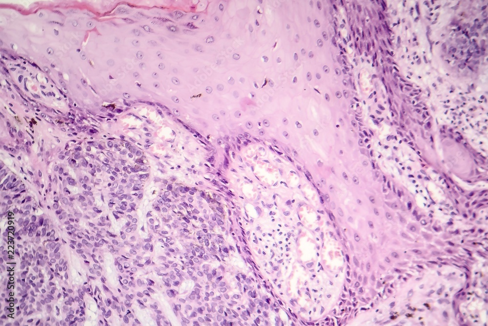 Basal cell carcinoma, skin cancer, light micrograph, photo under ...