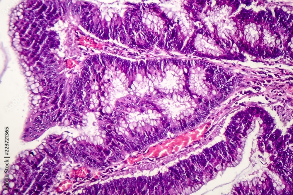 Colon adenocarcinoma, light micrograph, photo under microscope Stock ...