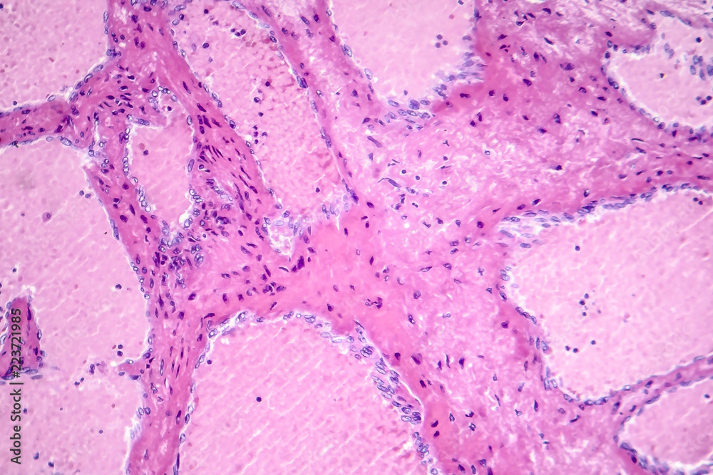 Hepatic cavernous hemangioma, a benign liver tumor, light micrograph ...