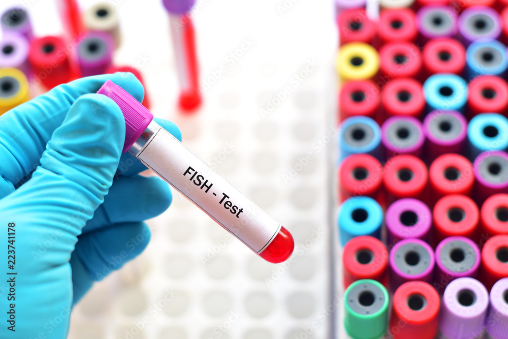 Blood sample for fluorescence in situ hybridization or FISH test ...