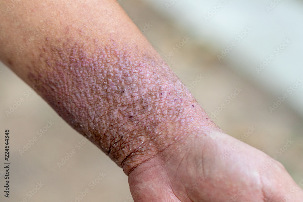 A physical of Atopic dermatitis (AD), also known as atopic eczema, is a ...
