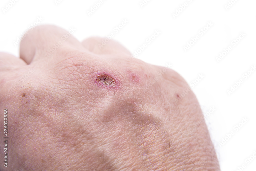 The wound on the hand. Scab after a few days. Stock Photo | Adobe Stock