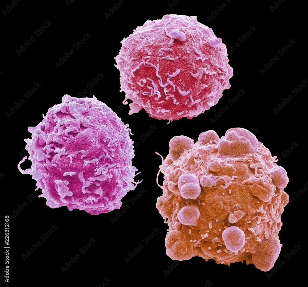 Colorectal cancer cells, SEM Stock Photo | Adobe Stock