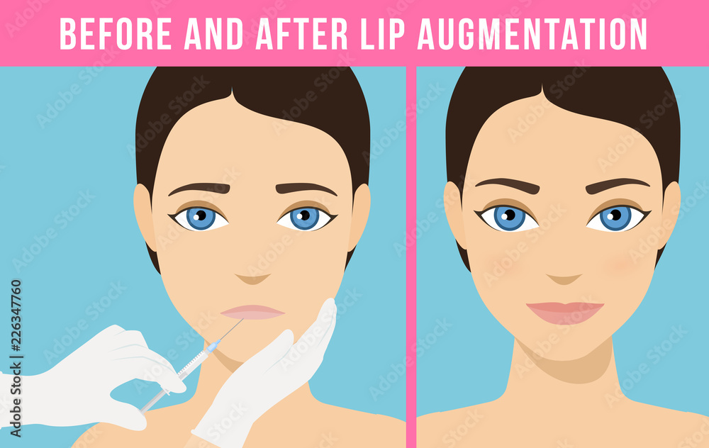 Woman makes procedure of beauty injection for lip augmentation. Lips ...