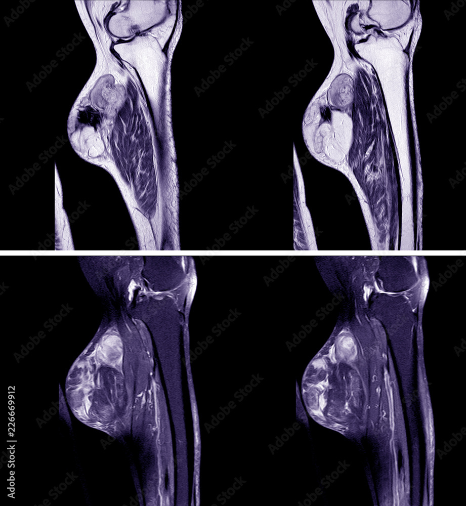MRI (Magnetic resonance imaging) of Leg.A large, well-circumscribed ...