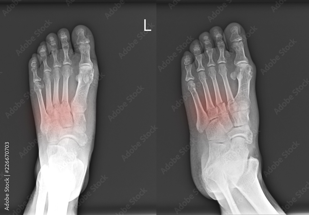 X-ray foot AP OBLIQUE Fracture proximal metaphysis of the 2nd,3rd,and ...