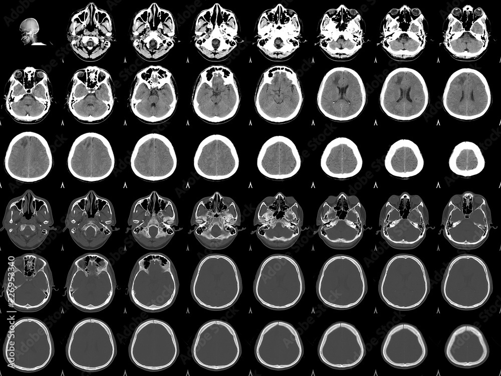 CT Scan Brain a male 38 year old.Finding Fracture frontal bone with ...