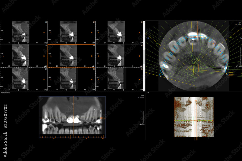 Dental 3D X-Ray of teeth Stock Photo | Adobe Stock