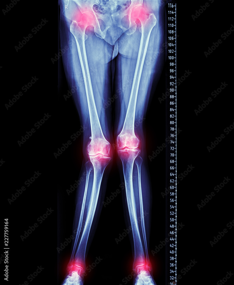 scanogram of lower limb. Medical background. Stock Photo | Adobe Stock