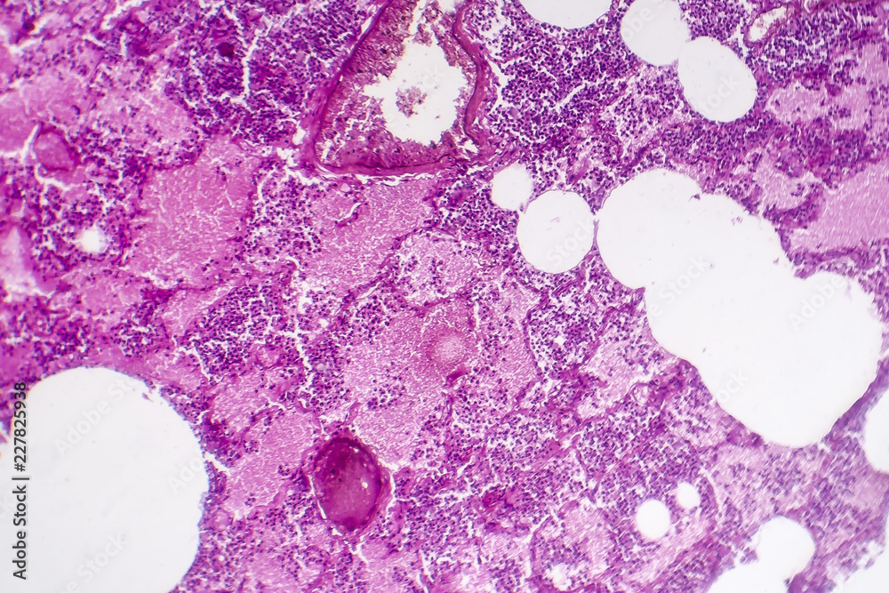 Lobar pneumonia, hemorrhagic edema period, light micrograph, photo ...