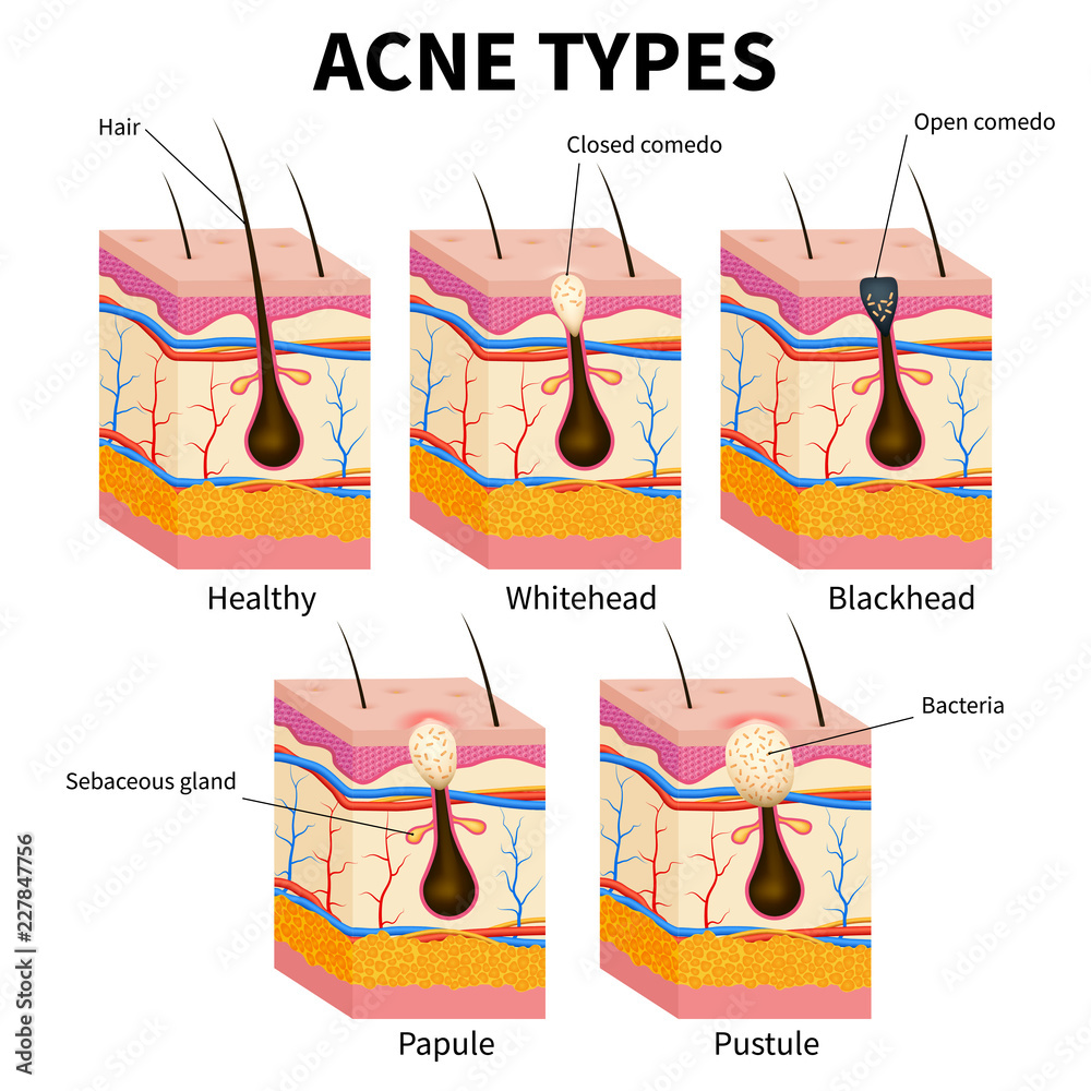 Acne types. Pimple skin diseases anatomy medical vector diagram ...