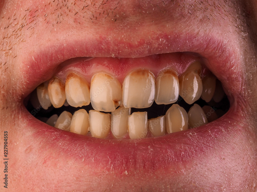 Dental medicine and healthcare - human patient open mouth showing ...