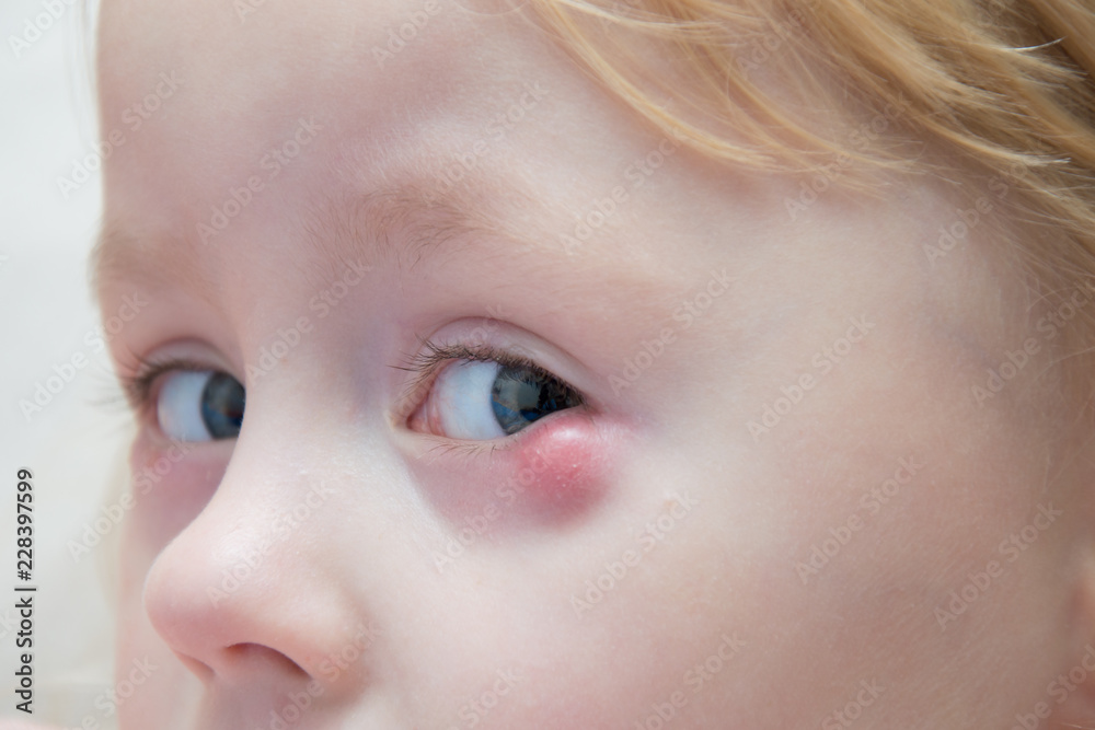 Nasolacrimal Duct Obstruction on Children,Establishing the Diagnosis ...