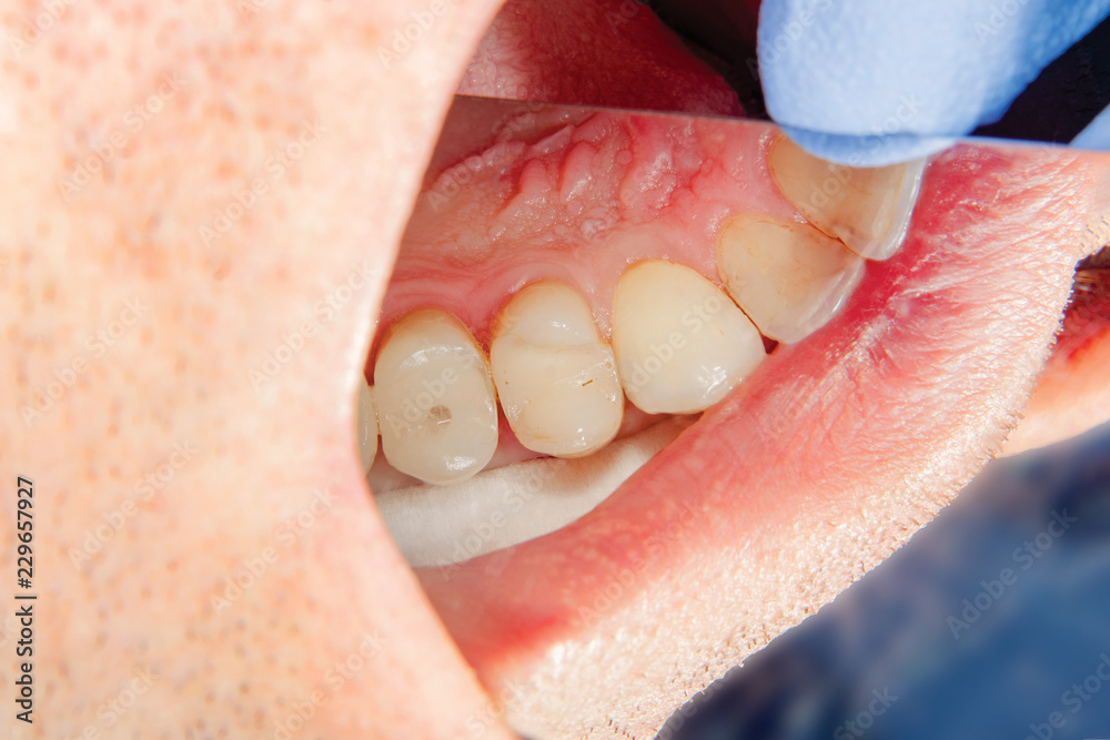 two chewing side teeth of the upper jaw after treatment of caries ...