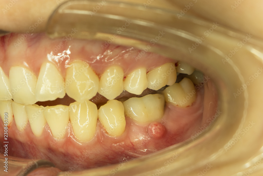 gum swelling from dental root abscess Stock Photo | Adobe Stock