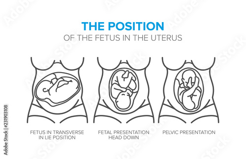 the position of the fetus in the womb Stock Vector | Adobe Stock