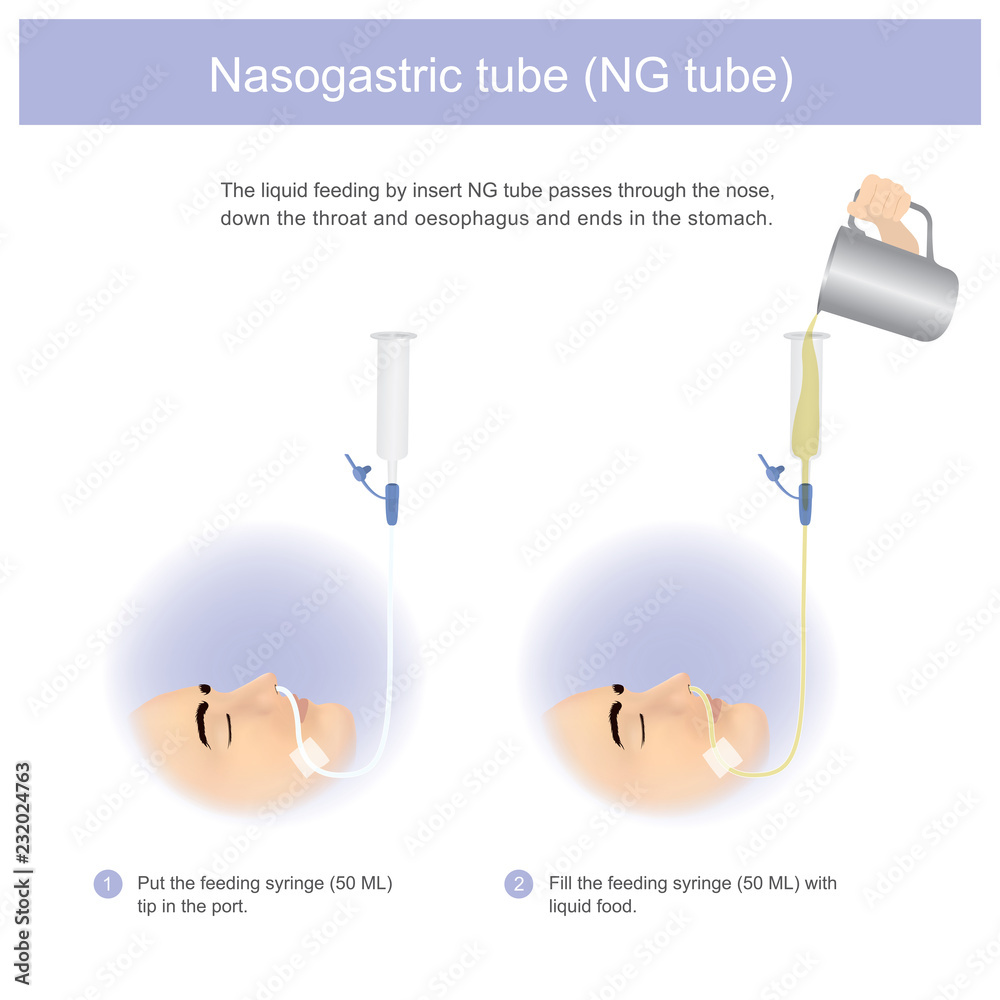Nasogastric tube. The liquid feeding by insert NG tube passes through ...