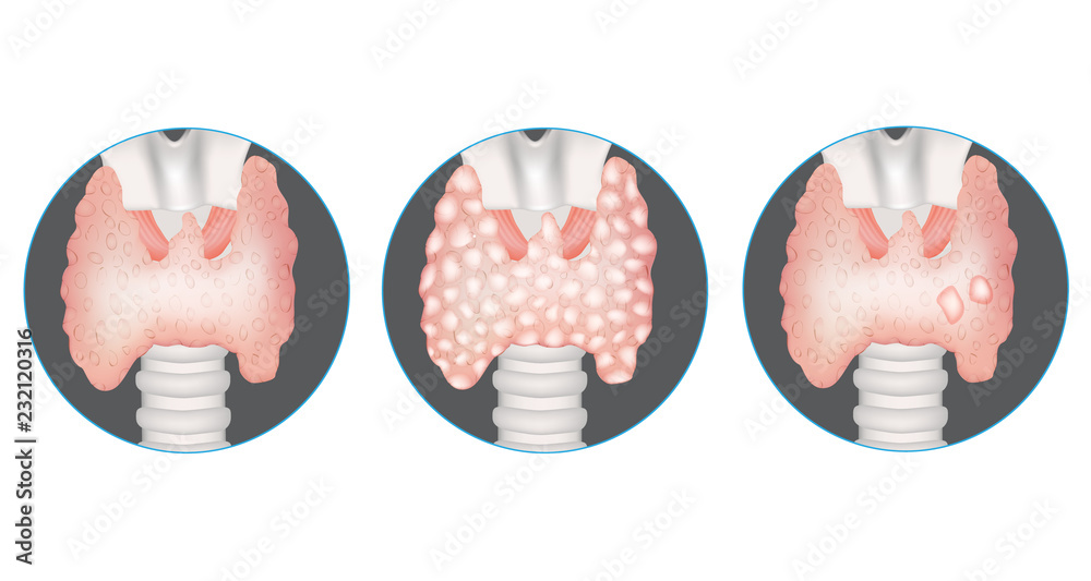 เวกเตอร์ Stock Thyroid gland diseases. Healthy thyroid, multinodular ...