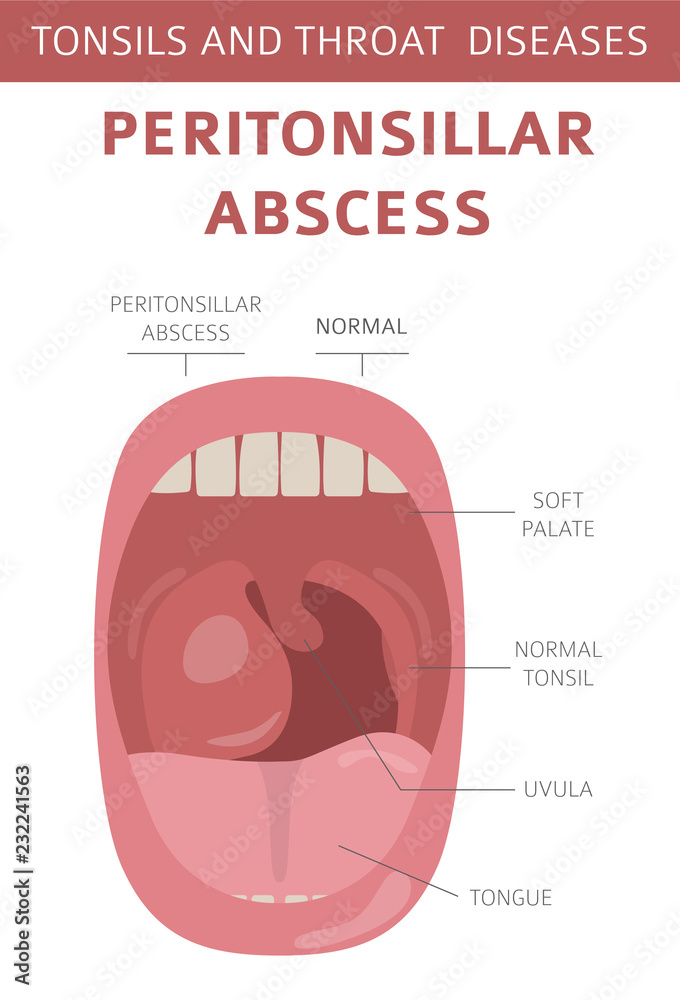 Tonsils and throat diseases. Peritonsillar abscess symptoms, treatment ...