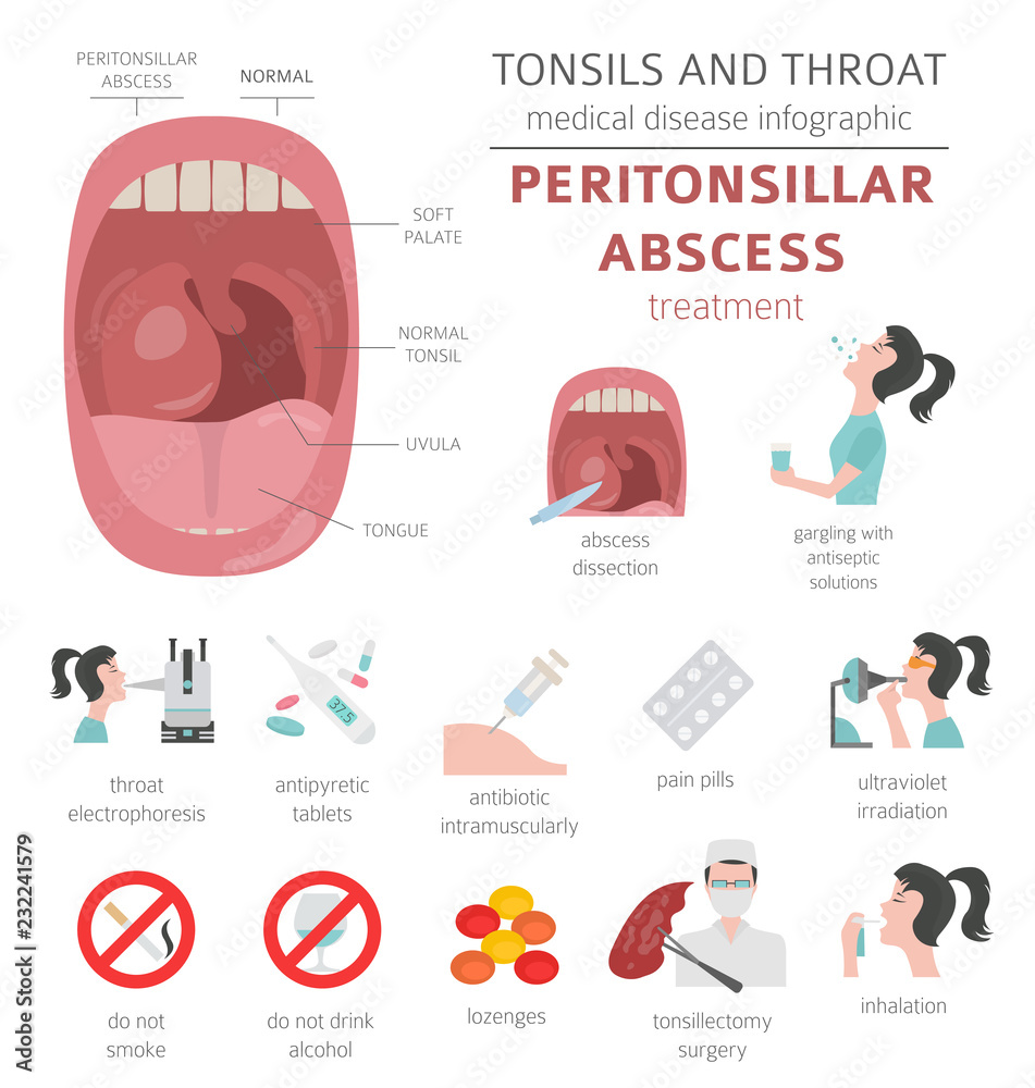 Tonsils and throat diseases. Peritonsillar abscess symptoms, treatment ...