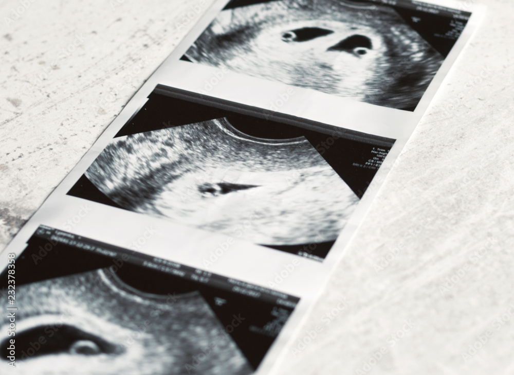 Snapshot of twins on the ultrasound at the stage of embryos. Ultrasound ...
