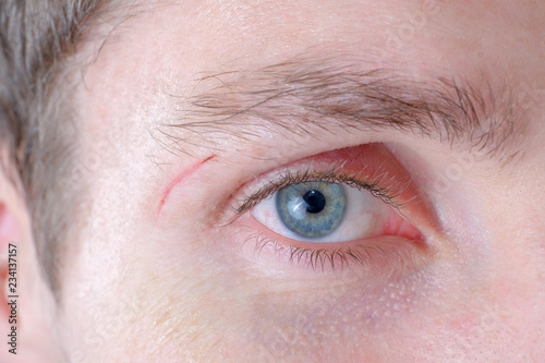 A scar near the eye with an eyebrow on a man of European appearance ...