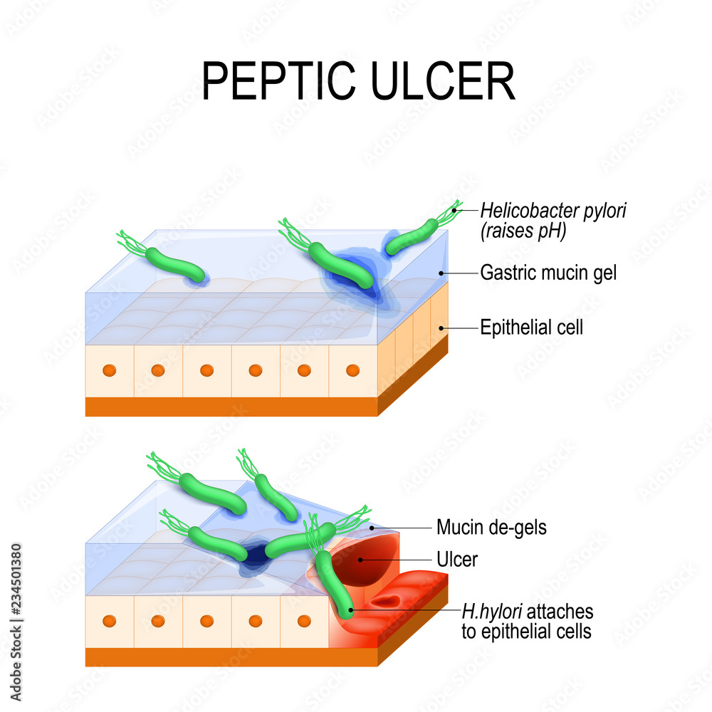 Peptic ulcer and bacterial infection. Helicobacter Pylori Stock Vector ...