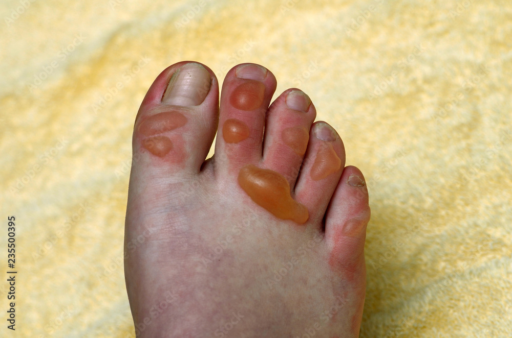 blistered toes resulting from hot water burn Stock Photo | Adobe Stock