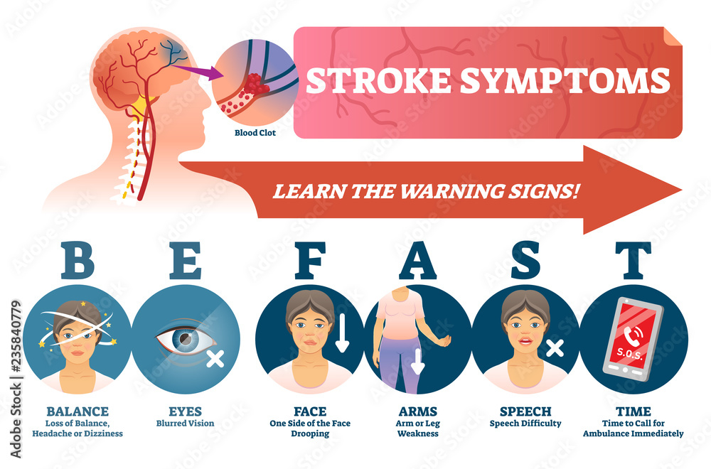 Stroke symptoms vector illustration. Signs of sudden blood clot in head ...