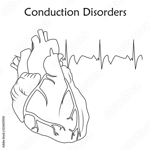 Human heart. Conduction Disorders. Anatomy flat illustration. Outline ...